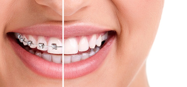 Dental-braces-cost - Sprout Dental